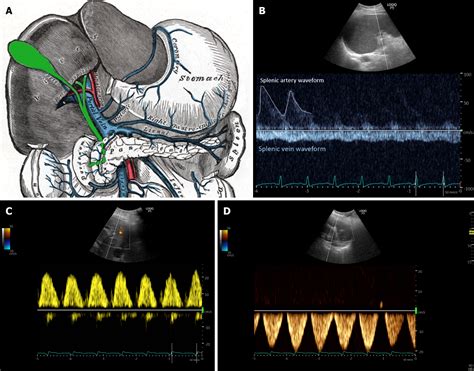 Extended Venous Excess Ultrasound A Promising Addition To Point Of