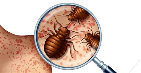 How To Tell The Difference Between Hives And Bed Bug Bites Imagine Care