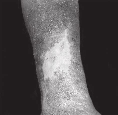 Final Phase Of Treatment Using Ulmo Honey And Ascorbic Acid Of Type 3