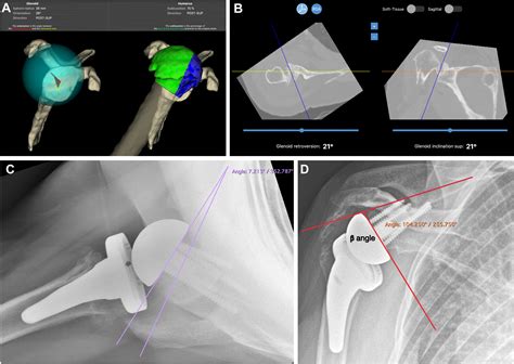 Bio Rsa Vs Metal Augmented Baseplate In Shoulder Osteoarthritis With