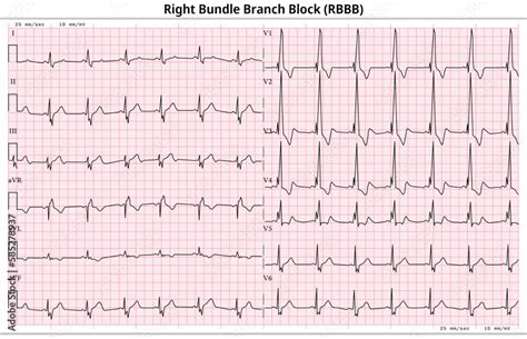 Ecg Rbbb Right Bundle Branch Block 12 Lead Ecg Common Case 6 Sec Lead Vector