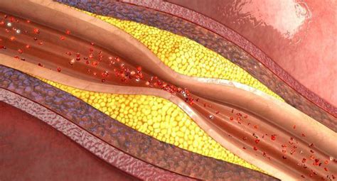 动脉粥样硬化（1）：动脉粥样硬化的疾病概述与定义 知乎