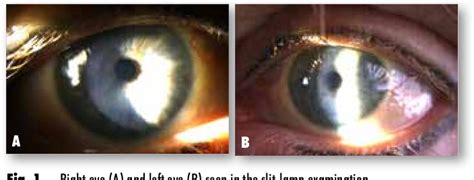 Figure 1 From Cornea Verticillata A Rare Complication Of Chloroquine Toxicity Case Report