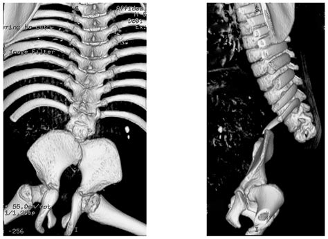 Caudal Regression Syndrome—a Narrative Review An Orthopedic Point Of View