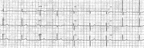 Ecg Cases 41 Stemi Occlusion Mi Complications