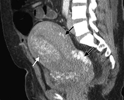 Ct Scan Uterus At Maryann Diggs Blog