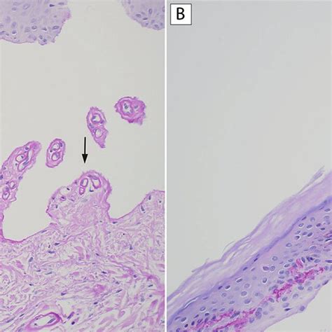 Histological Findings In Porphyria Cutanea Tarda Pct Periodic