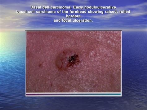 Oral Basal Cell Carcinoma