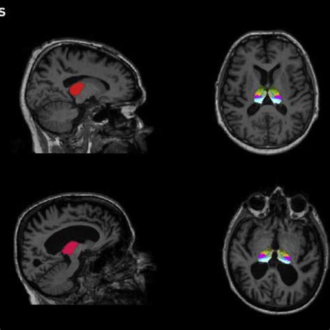 Segmentations Of Thalamic Subnuclei In Healthy Controls Hc And