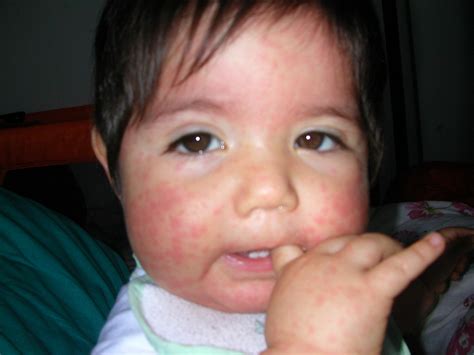 Reacao Alergica Cutanea A Amoxicilina Alergia A La Amoxicilina En