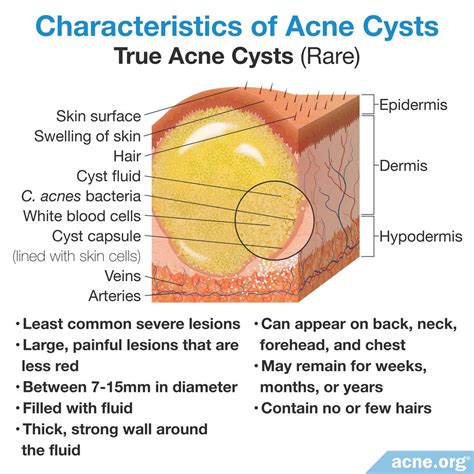 Sebaceous Cyst In Groin Area Male At Walter Mcglothlin Blog