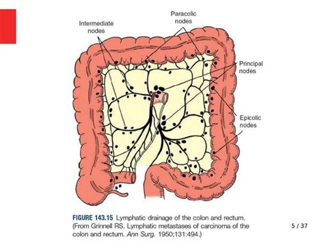Lt Hemicolectomy Surgical Approach Complications Pdf