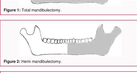 Figure 8 From Classification Of Mandibulectomy Mandibular Defects