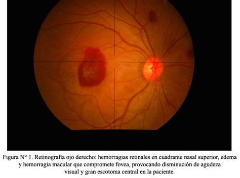 Hemorragia Macular En Anemia Aplásica Reporte De Un Caso