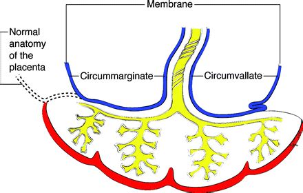 Circumvallate Placenta Diagram