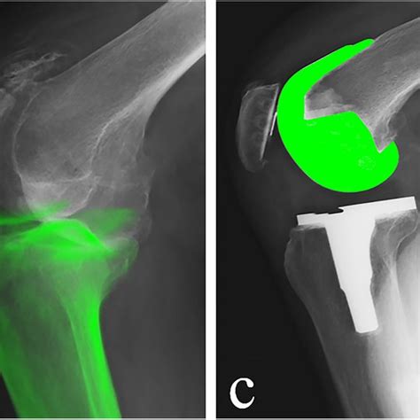 Computed Tomography Slices Were Used To Create Density Based Digitally