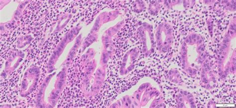 Human Gastric Stomach Adenocarcinoma FFPE Sections