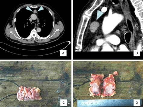 A Chest Ct Showed A Mass Of Soft Tissue Density In The Anterior