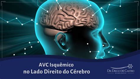 Sequelas De Avc Isquêmico No Lado Direito Do Cérebro Dr Diego De Castro