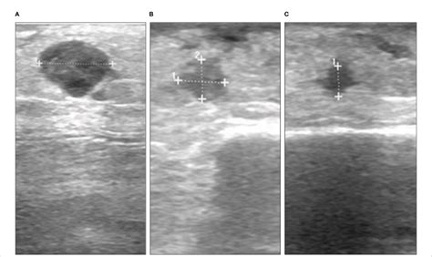 Course Of A Subcutaneous Melanoma Metastasis Under Combination Of Mek