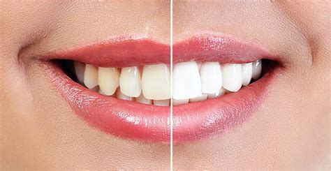 Professional Teeth Whitening In Round Rock Teeth Whitening Dentist Near Me Nuyu Dental