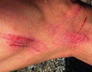 Injury Description In The Ed Emergency Trauma Management