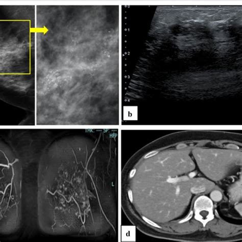 Imaging Findings A Mammogram Shows Segmental Polymorphic Download