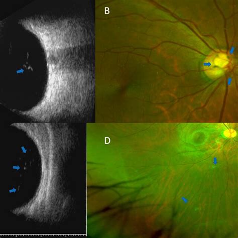 The Other Retinal Abnormalities Noted On Optos Images Download Scientific Diagram