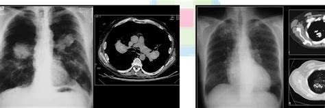 Chest Radiograph And An Axial Ct Scan Shows Calcification