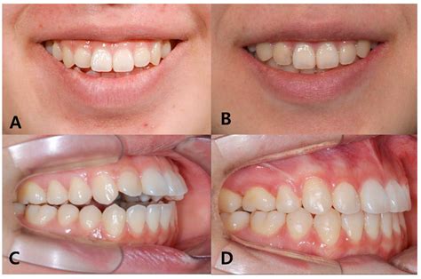 Open Bite Correction Using A Mid Palatal Tad With An Intrusion Tpa