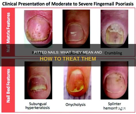 Pitted Nails What They Mean And How To Treat Them Nailicy