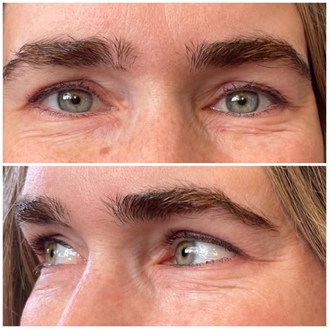 Upper Lower Bleph Or Brow Lift R Plasticsurgery