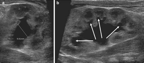 Postnatal Us Examination In A 5 Week Old Girl With Urinary Tract