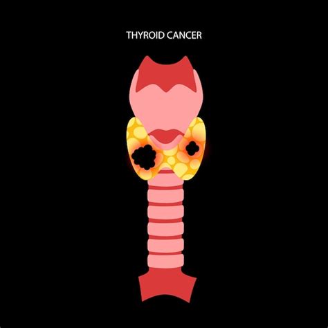Premium Vector Thyroid Cancer Stages