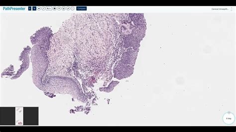 Cervix Under The Microscope Pap Hpv Lsil Hsil And Leep Pathagonia Youtube