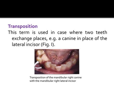 Classification Of Malocclusion Ppt