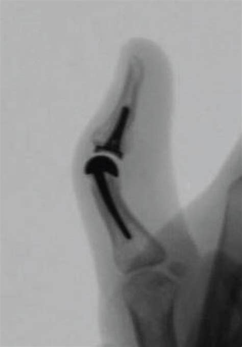 Lateral View Of The Thumb Ip Joint With The Implant In Place
