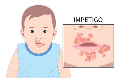 Impétigo Dans Le Nez