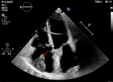 Atrial Thrombosis Not Only Left Think Also About Right Degiovanni