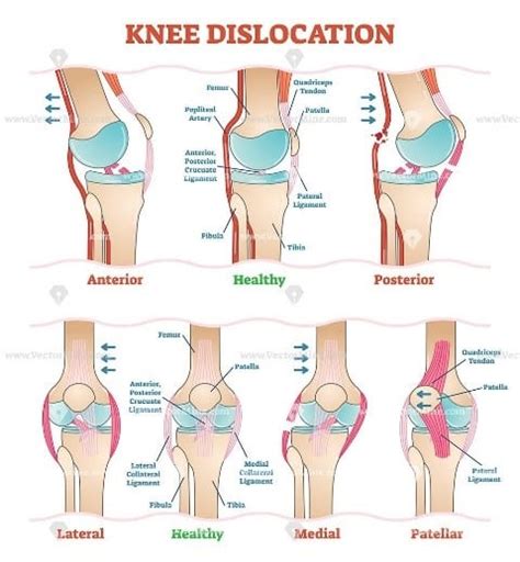 Knee Dislocation Multi Ligament Knee Injuries Lamberti Physiotherapy