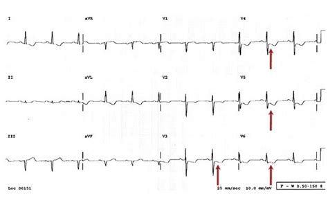 Aortic Dissection