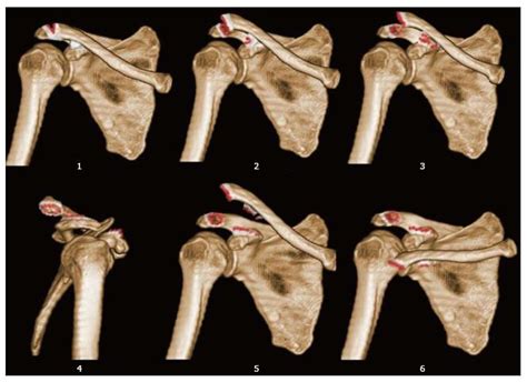 Ac Joint Dislocation