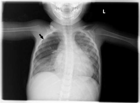 Congenital Lobar Overinflation Associated With Supracardiac Total