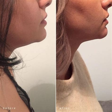Chin Sculpting Reviews And Results Reducing Fat Under The Chin
