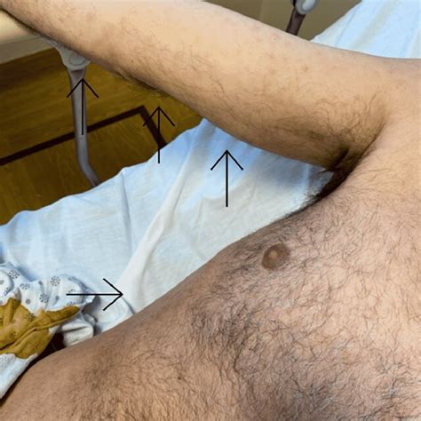 Maculopapular Rash Demonstrated On The Right Upper Extremity And Flank Download Scientific