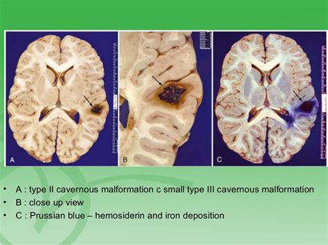 392 Natural History Of Cavernous Malformation