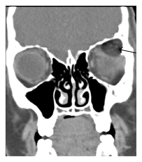 18 years old with diplopia axial ct with bone algorithm a shows a