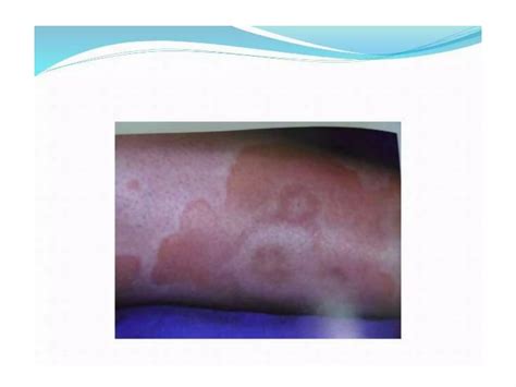 Cutaneous Vasculitis Ppt