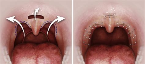 Uvulopalatopharyn­goplasty Patient Selection And Effects On The Airway