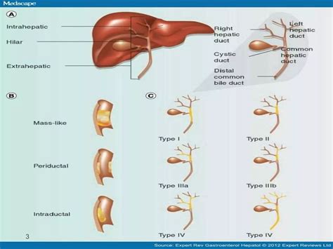 Billiary Tract Cancer Radiotherapy Pptx Digestive Disorders